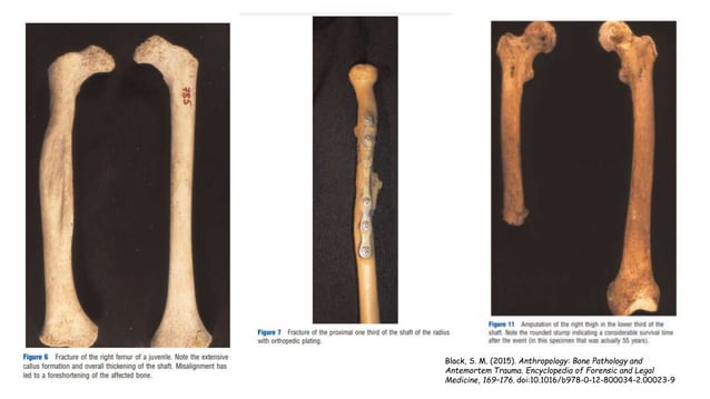 MSCIII_Forensic anthropology_Trauma analysis.pptx | Death, Injury, or ...