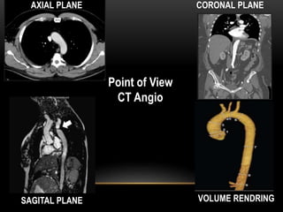 CT Imaging examination about aorta and it's disease | PPT