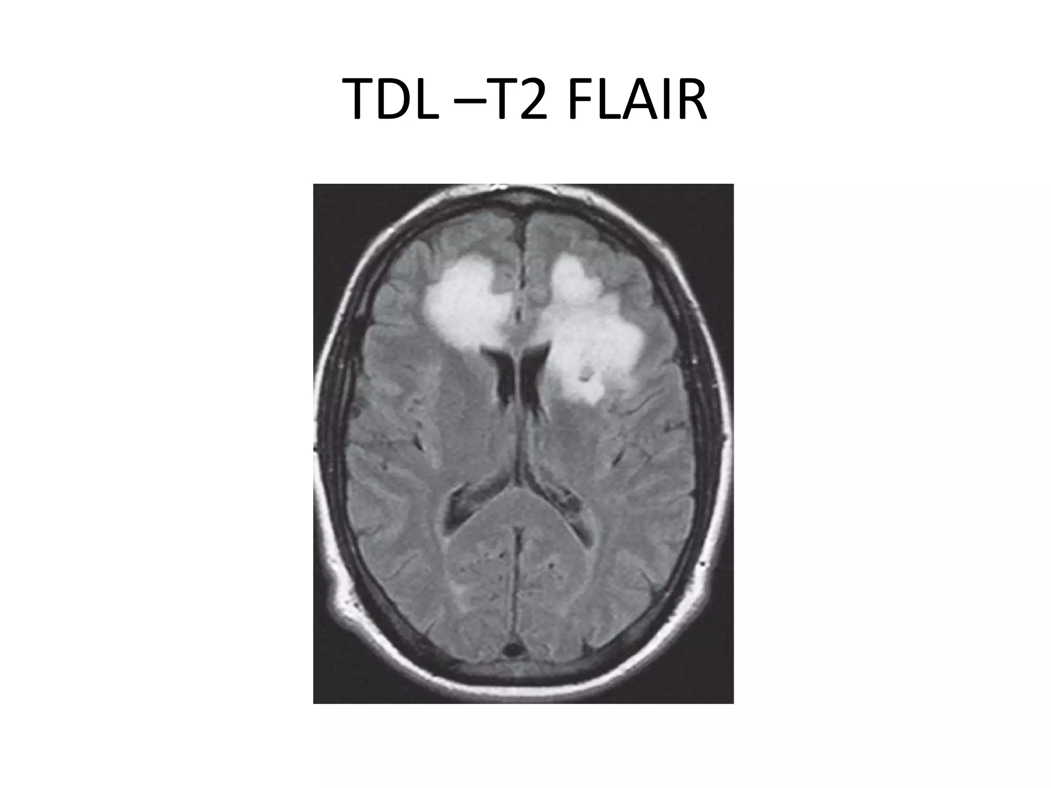 MRI differential diagnosis of Multiple sclerosis | PPTX