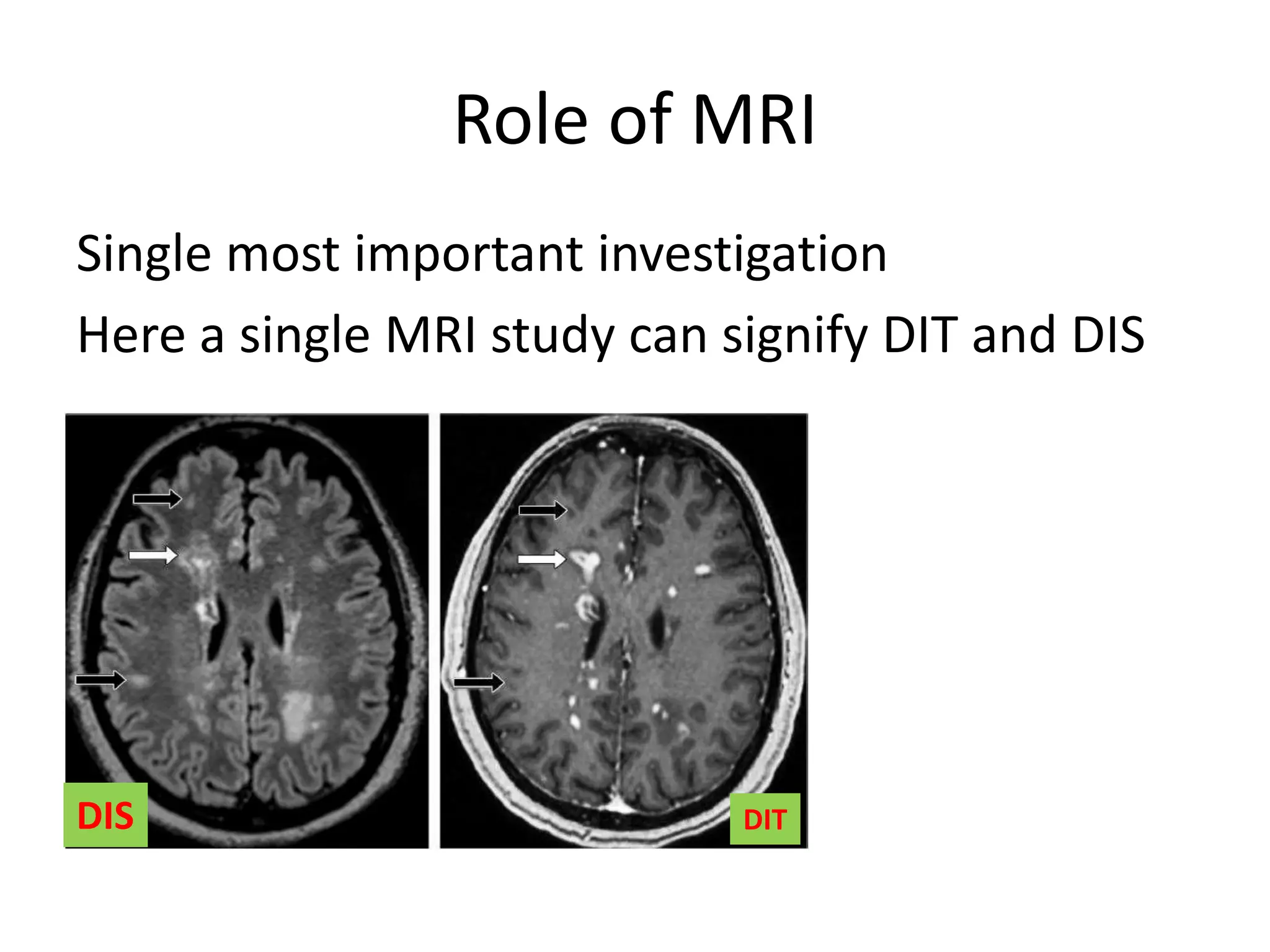 MRI differential diagnosis of Multiple sclerosis | PPTX