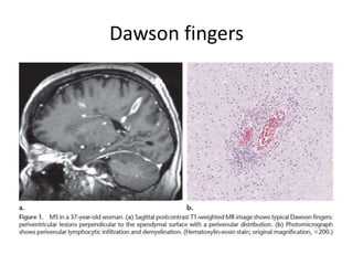 MRI differential diagnosis of Multiple sclerosis | PPTX