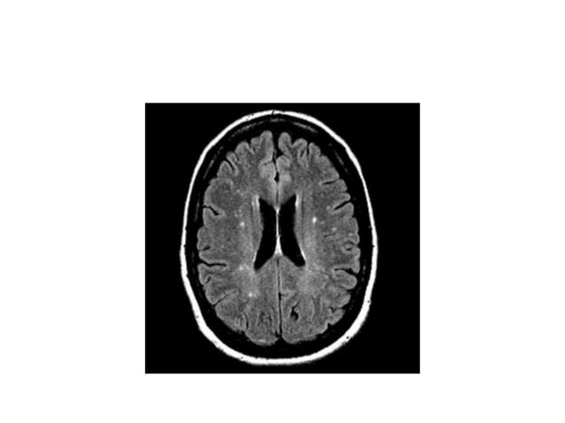 MRI differential diagnosis of Multiple sclerosis | PPTX