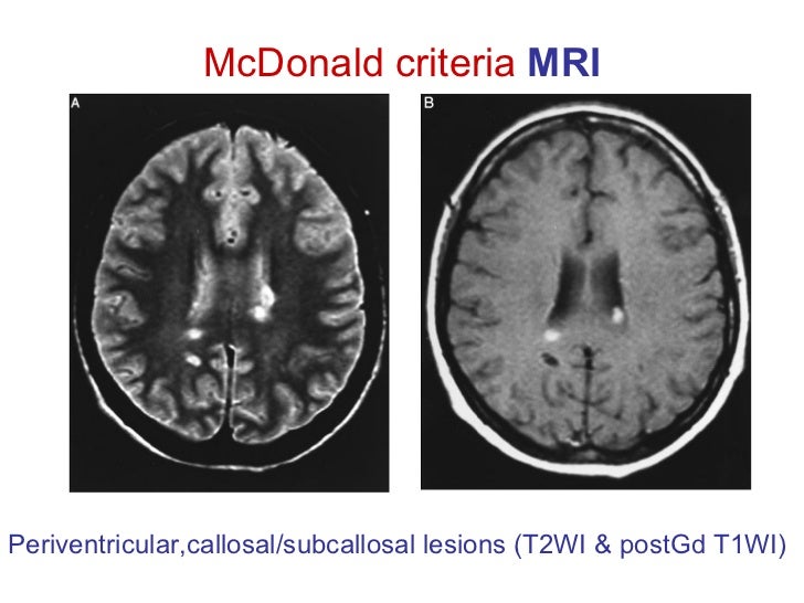 MS diagnostic criteria