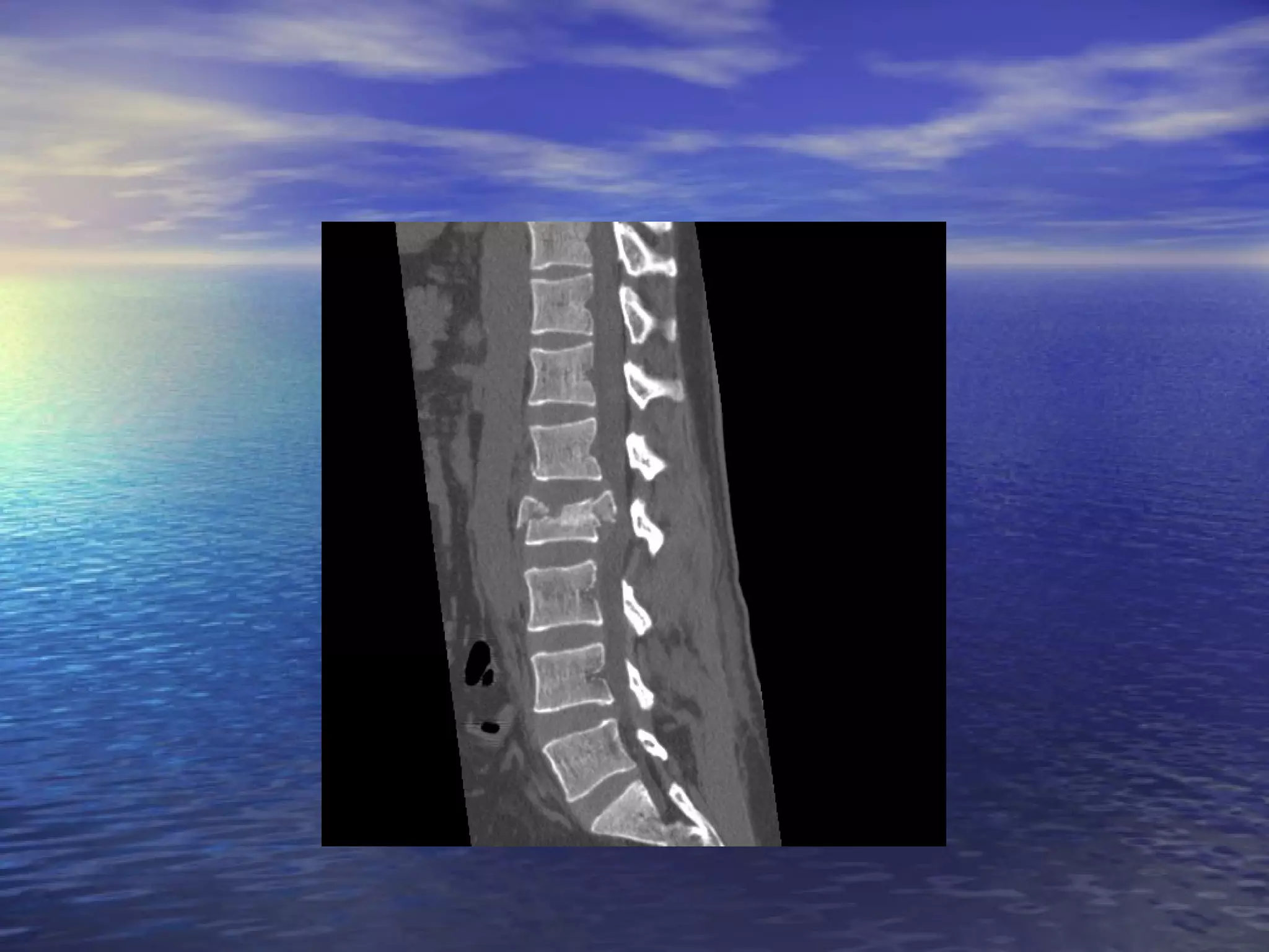 thoracolumbar fractures -anterior column reconstruction | PPT