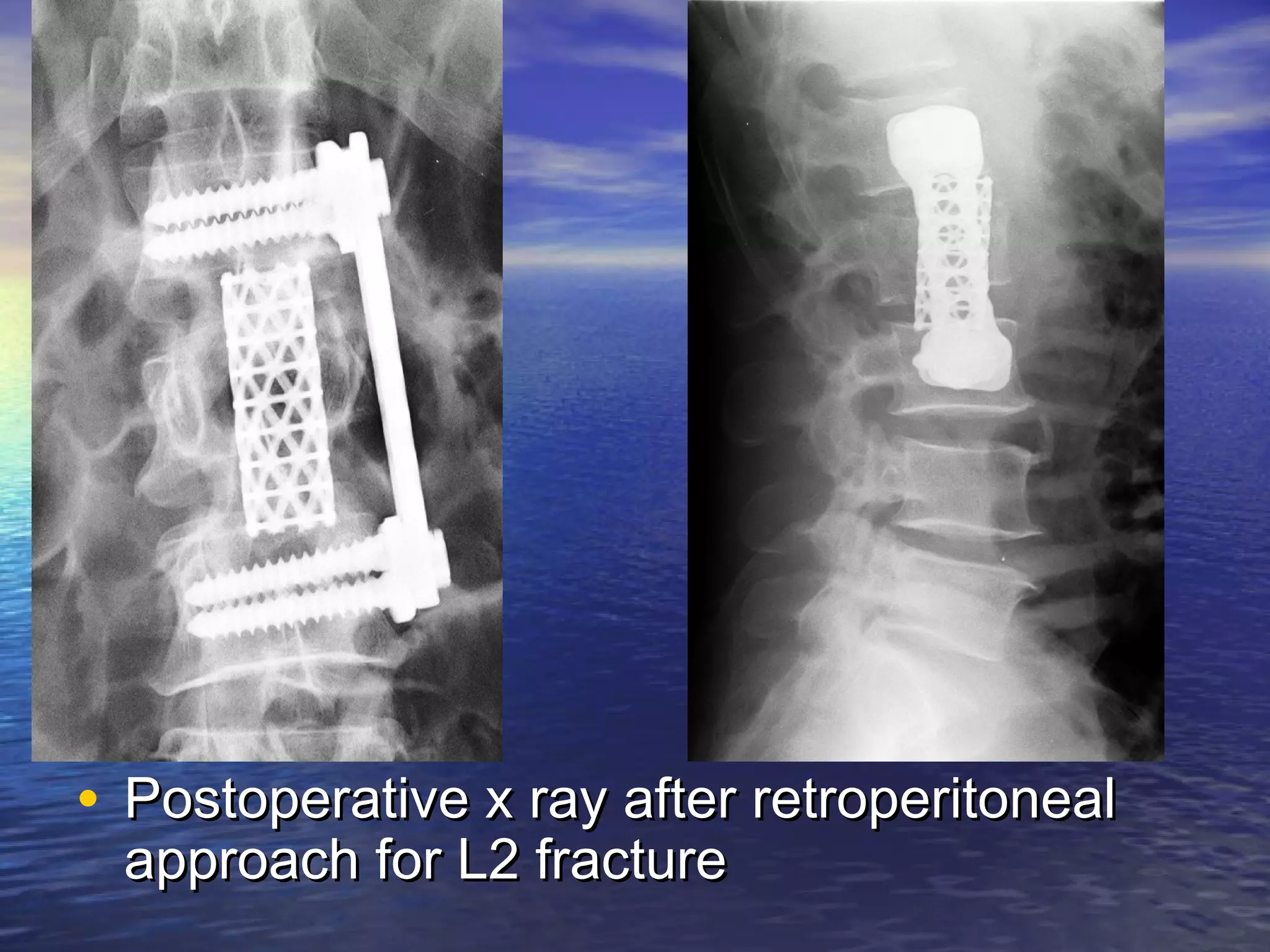 thoracolumbar fractures -anterior column reconstruction | PPT