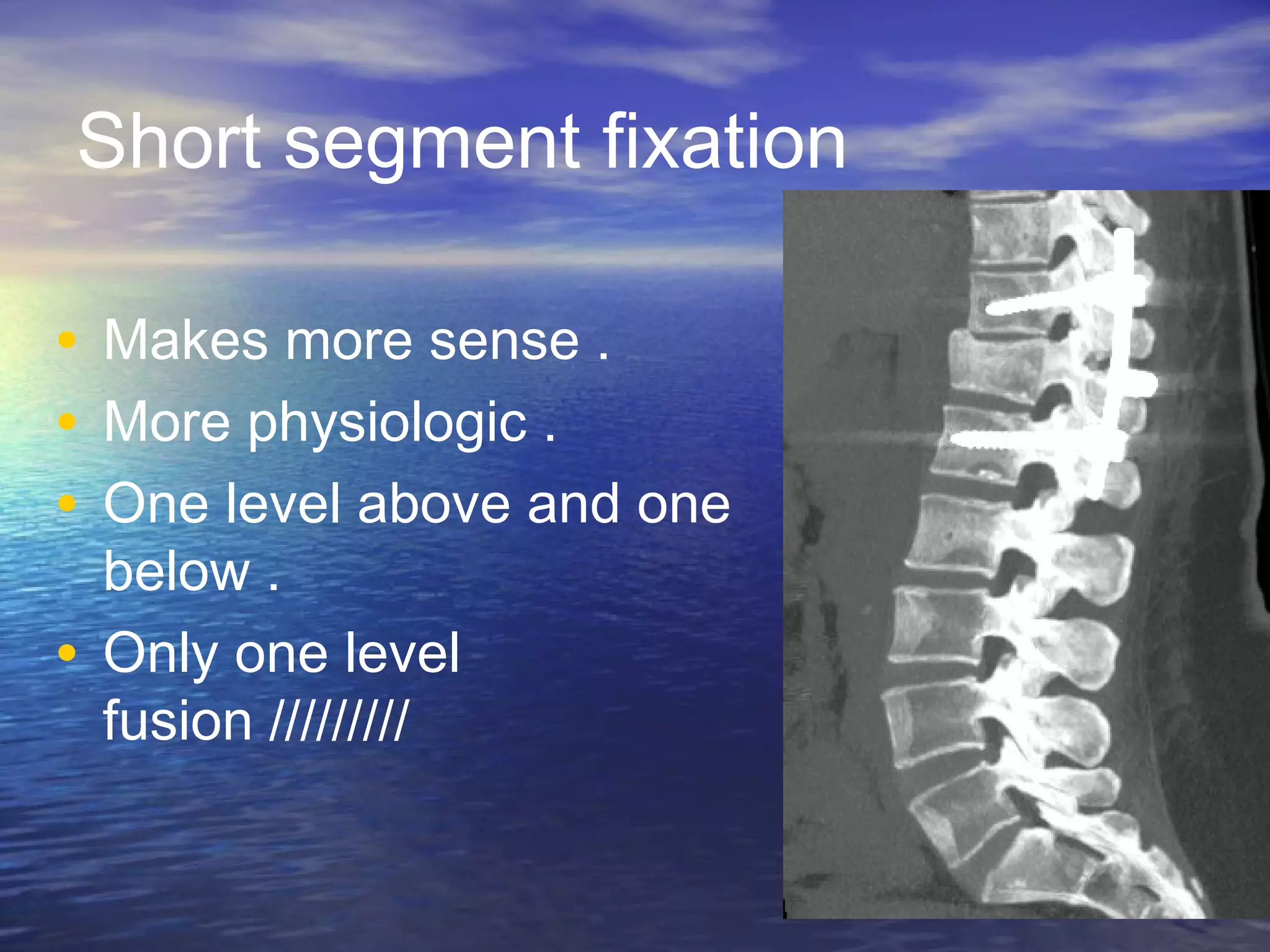 thoracolumbar fractures -anterior column reconstruction | PPT