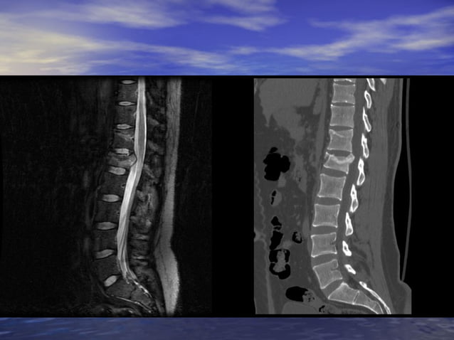 thoracolumbar fractures -anterior column reconstruction | PPT