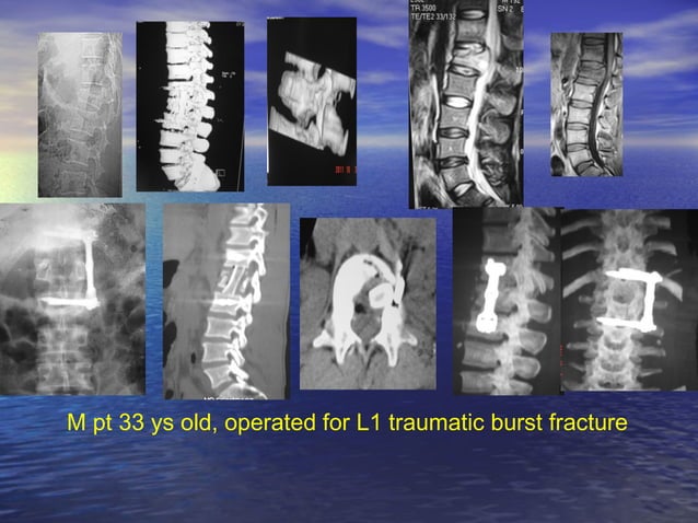 thoracolumbar fractures -anterior column reconstruction | PPT