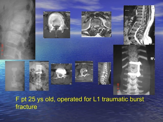 thoracolumbar fractures -anterior column reconstruction | PPT