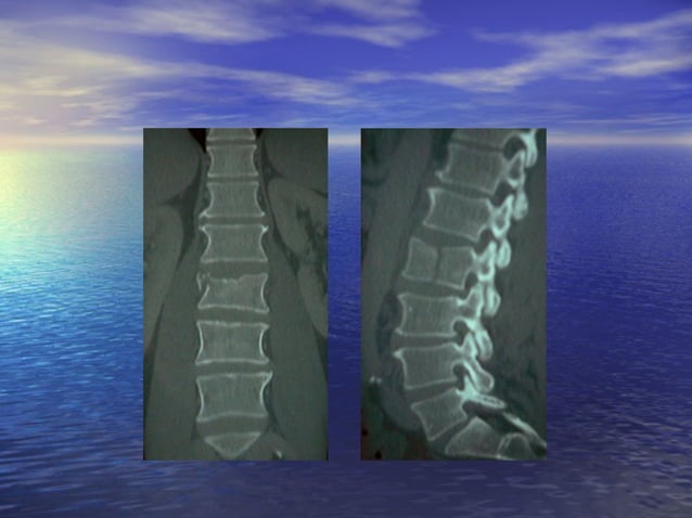 thoracolumbar fractures -anterior column reconstruction | PPT