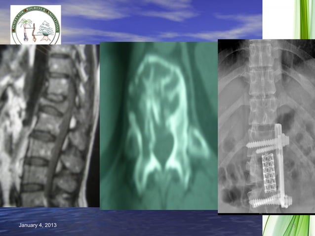 thoracolumbar fractures -anterior column reconstruction | PPT