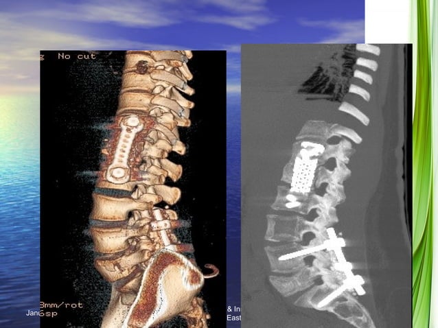 thoracolumbar fractures -anterior column reconstruction | PPT