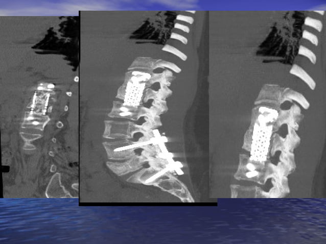 thoracolumbar fractures -anterior column reconstruction | PPT