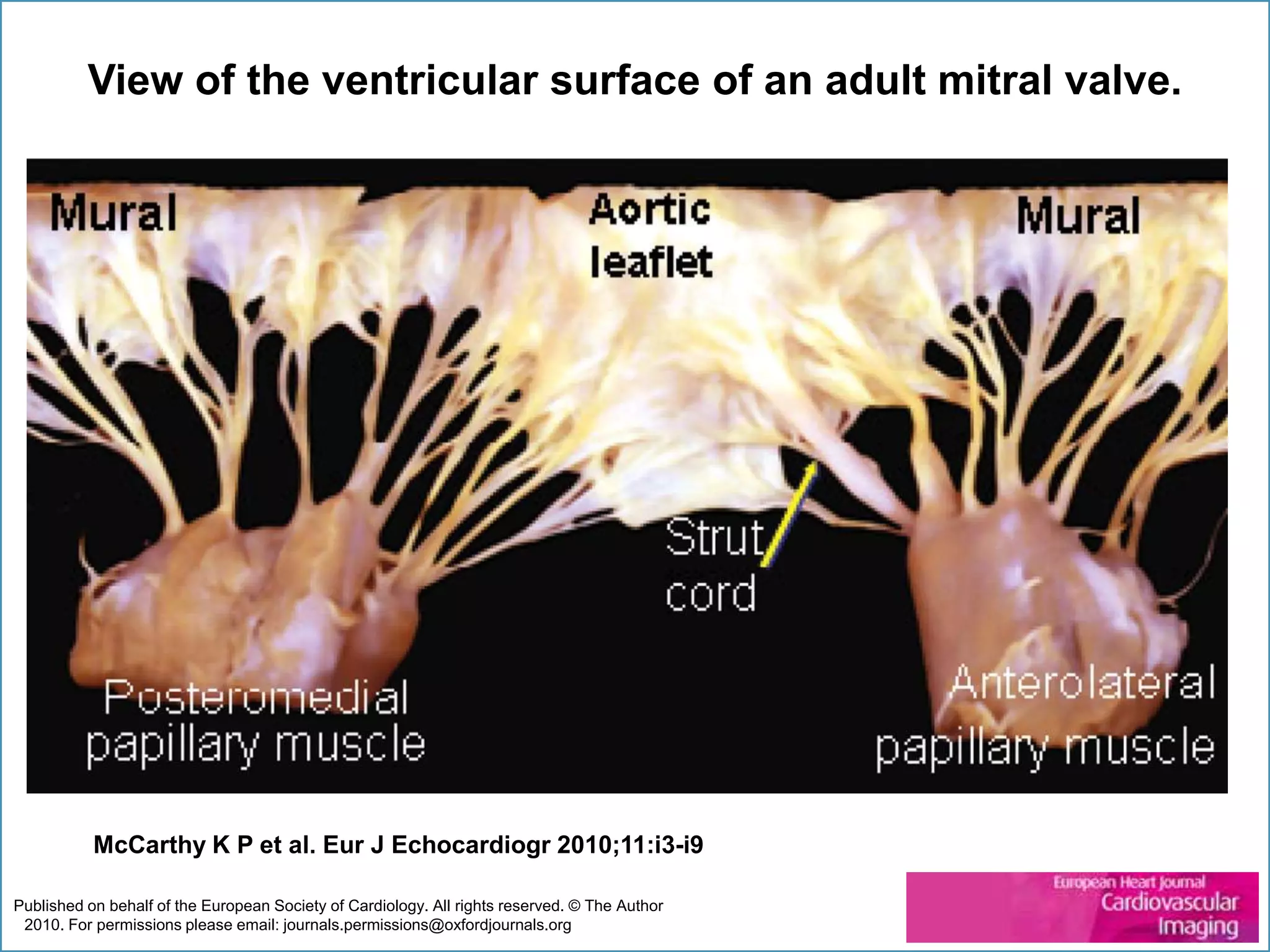 ECHOCARDIOGRAPHIC EVALUATION OF MITRAL VALVE DISEASE | PPTX