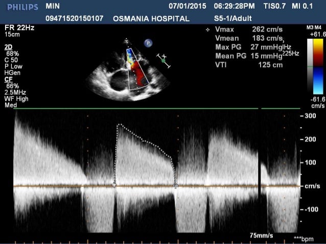 ECHOCARDIOGRAPHIC EVALUATION OF MITRAL VALVE DISEASE