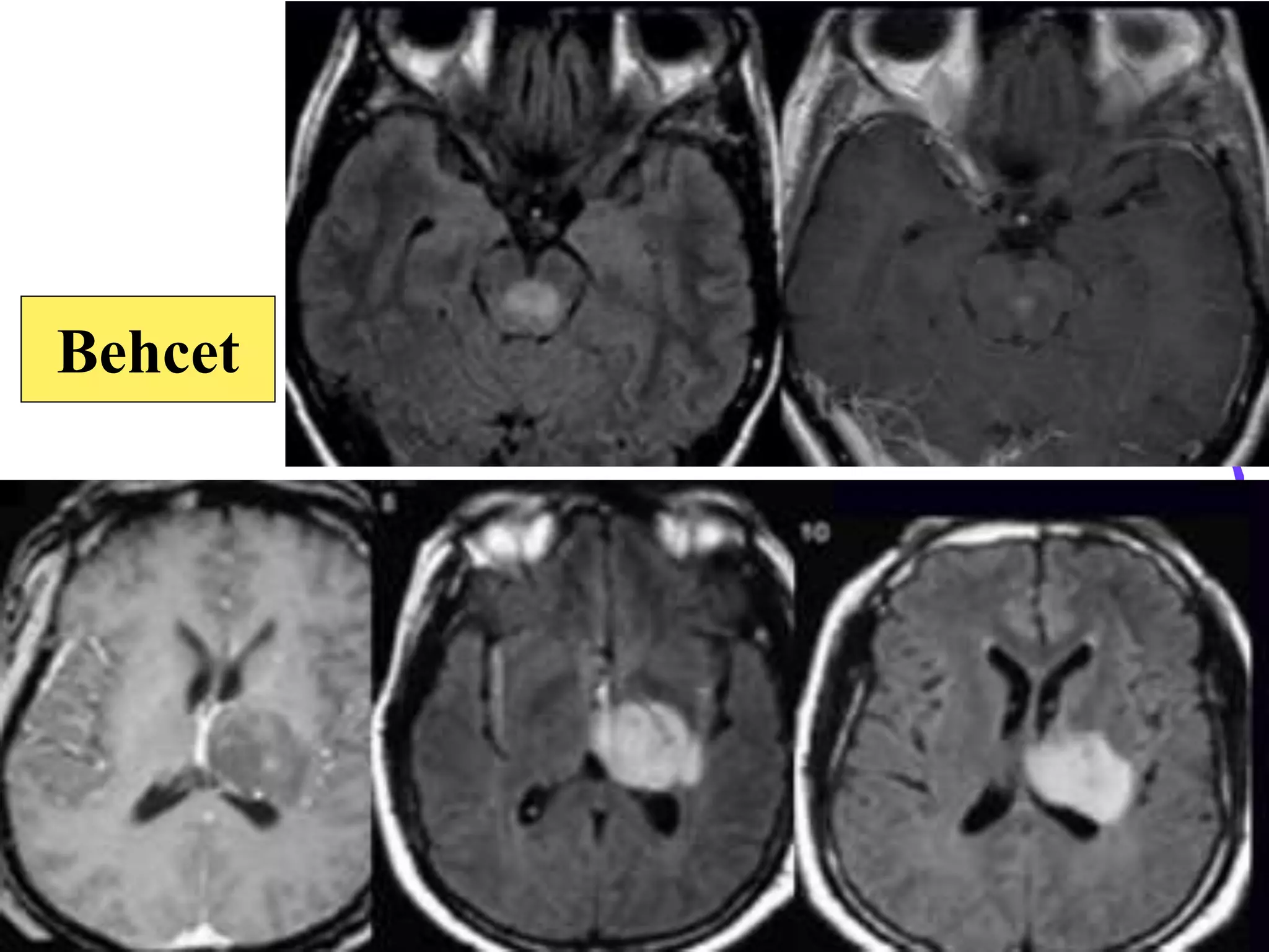 Multiple Sclerosis in children.ppt