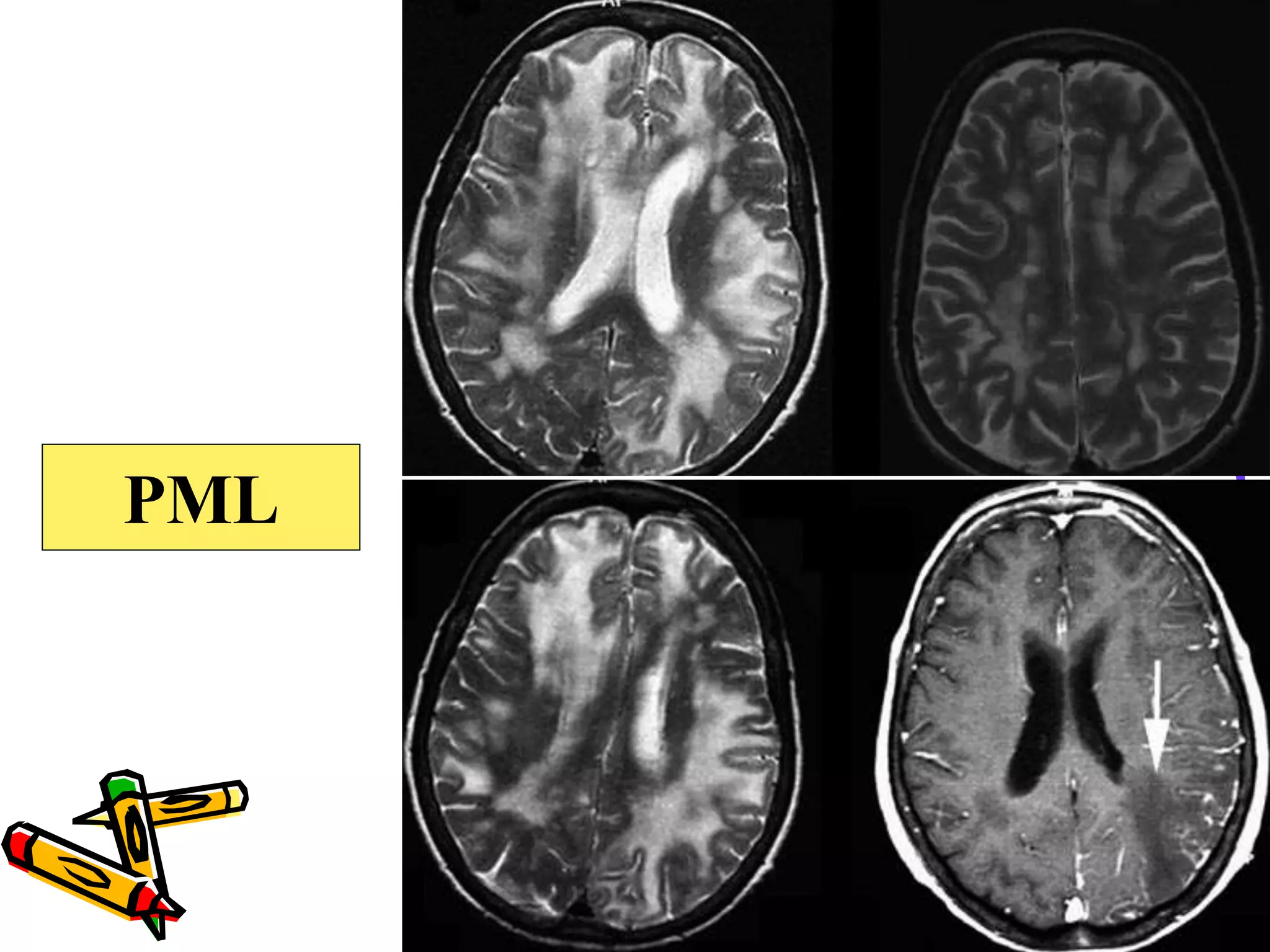 Multiple Sclerosis in children.ppt
