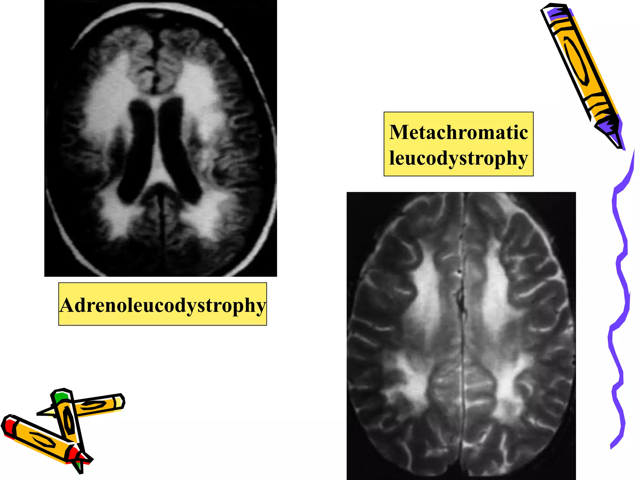 Multiple Sclerosis in children.ppt