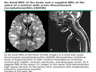 Multiple Sclerosis in children.ppt