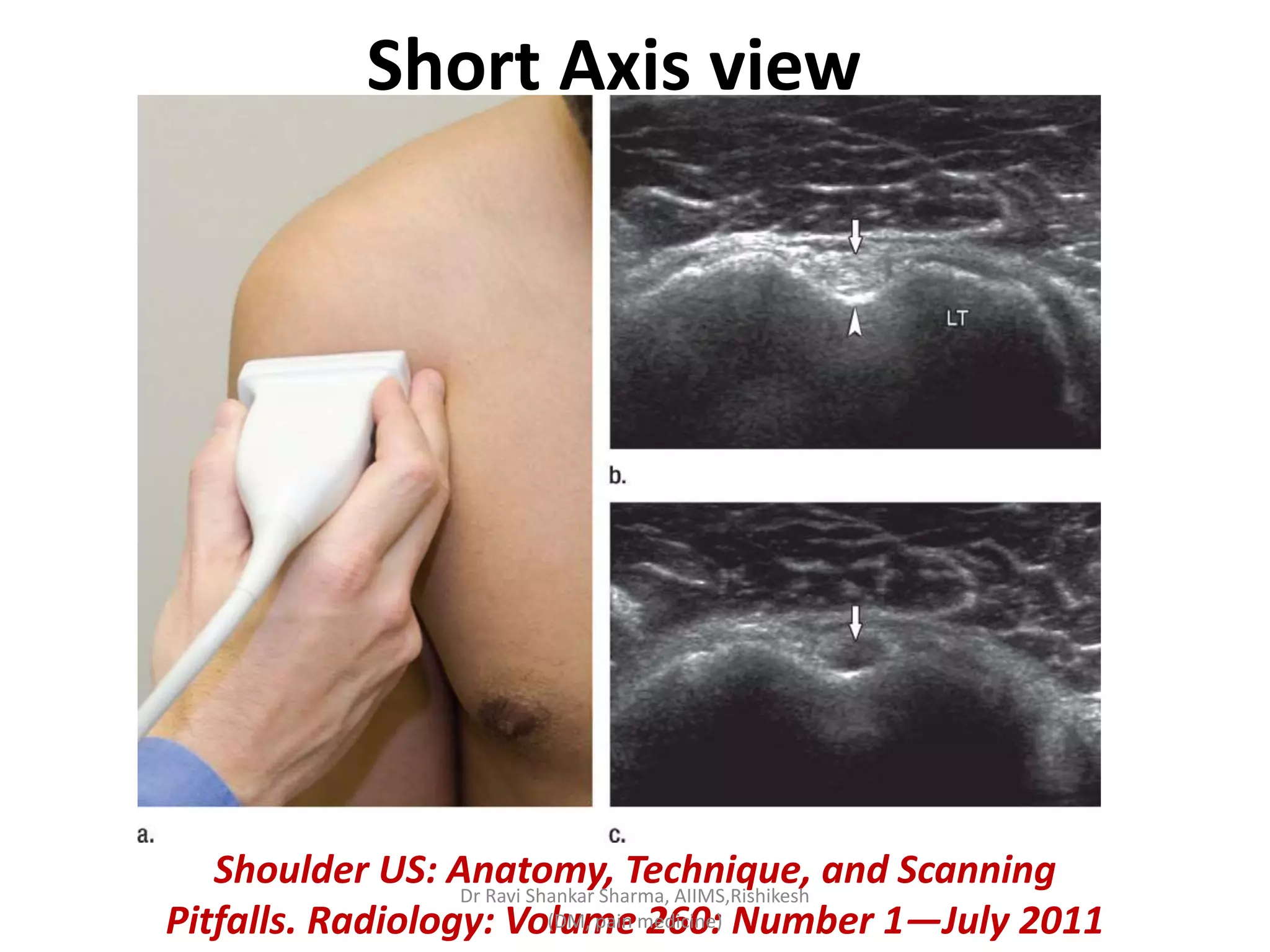 Diagnostic Ultrasound of shoulder | PPTX
