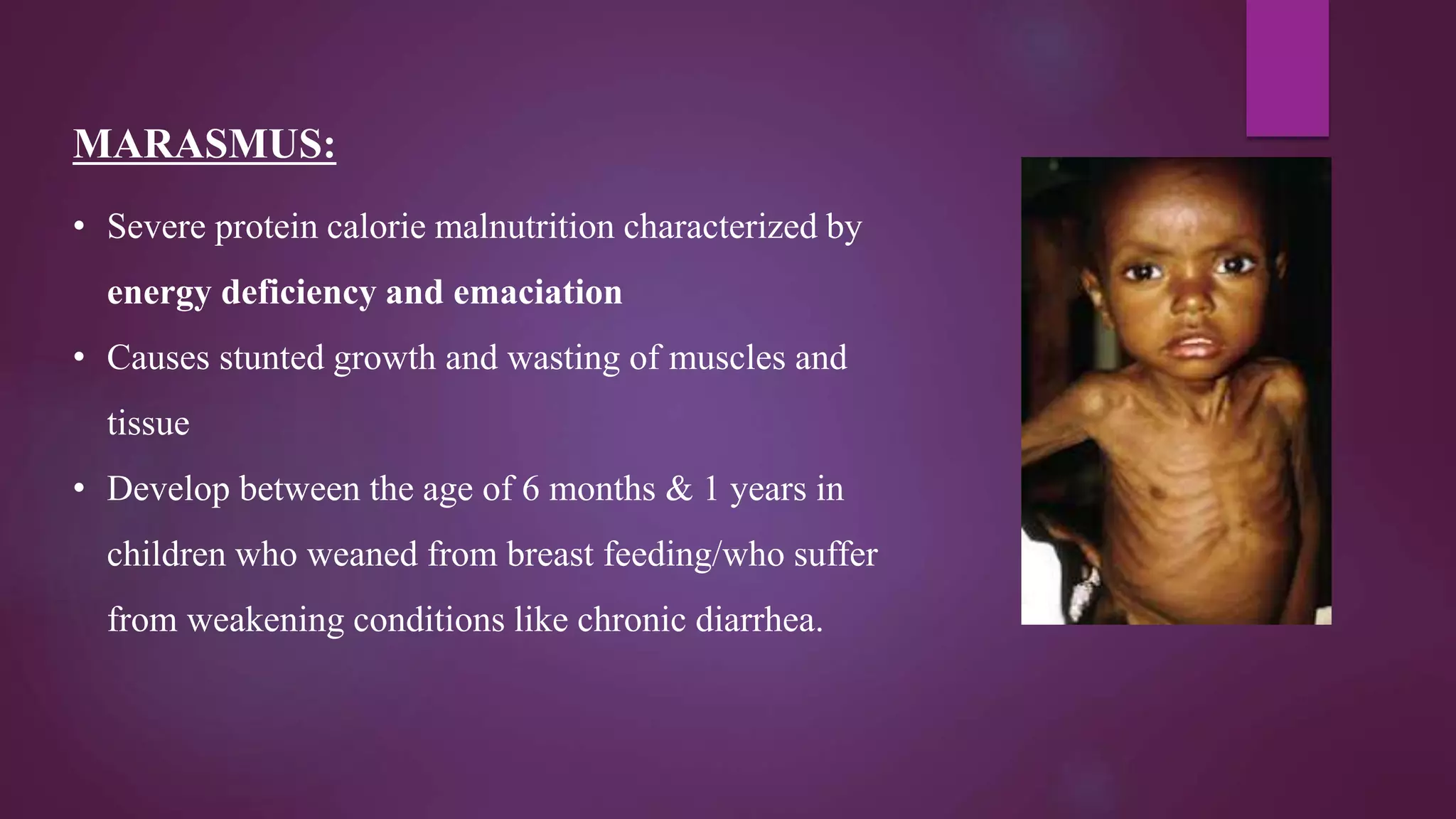 BALANCED DIET & TREATMENT & PREVENTION OF DEFICIENCY DISORDERS | PPTX