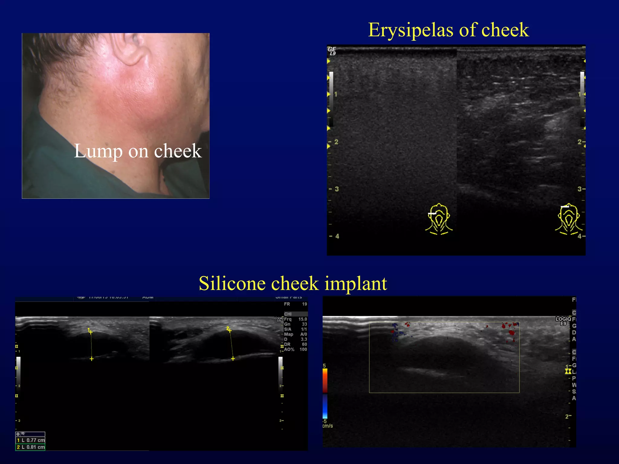 Msk need to know ultrasound lumps & bumps & various joints | PDF