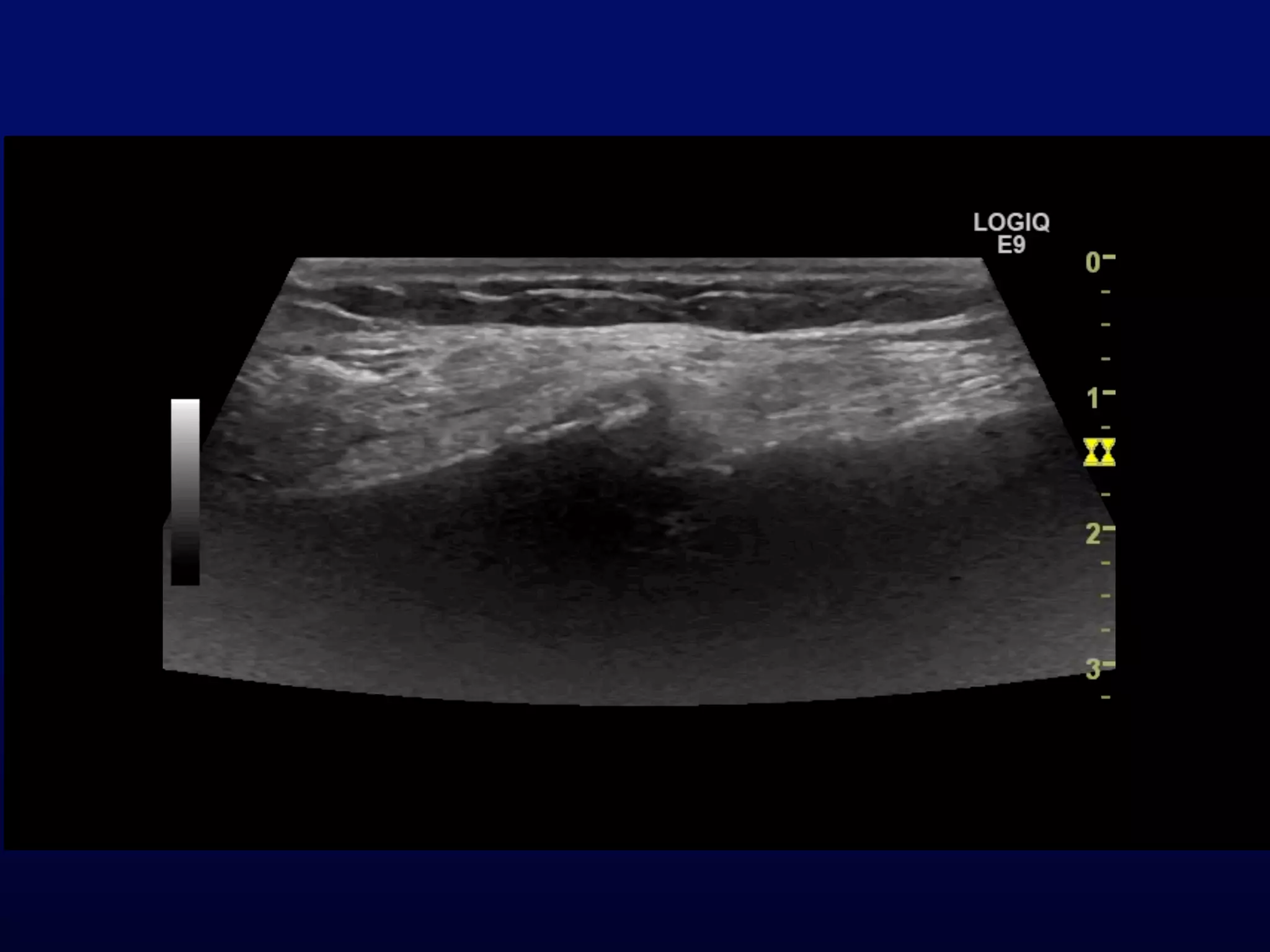 Msk need to know ultrasound lumps & bumps & various joints | PDF