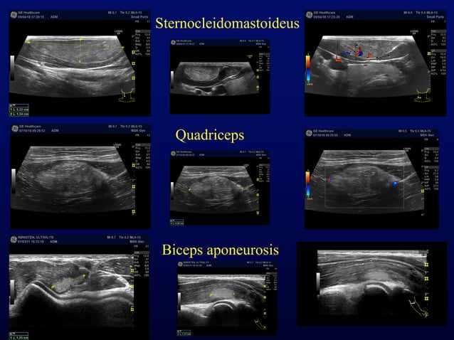 Msk need to know ultrasound lumps & bumps & various joints | PPT