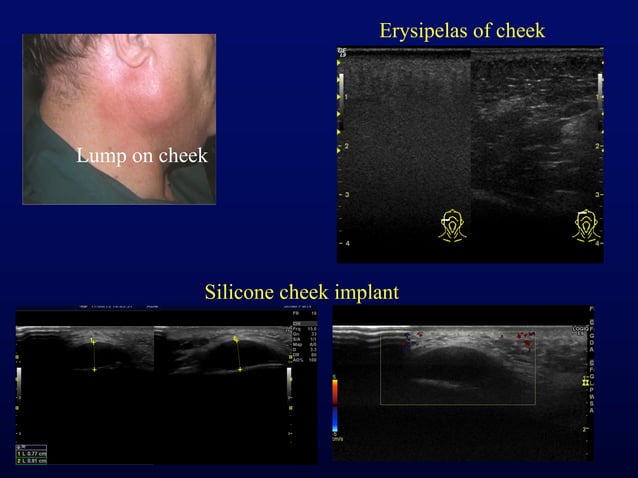 Msk need to know ultrasound lumps & bumps & various joints | PPT