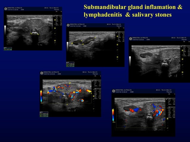Msk need to know ultrasound lumps & bumps & various joints | PPT
