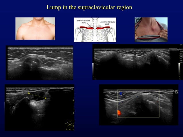 Msk need to know ultrasound lumps & bumps & various joints | PPT