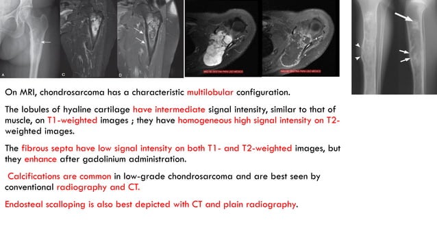 msk tumor.pdf