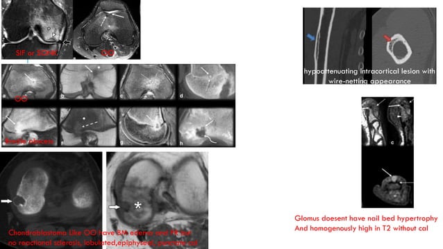msk tumor.pdf