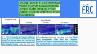 MSKUS in Sport Injuries - muscle pathology (preview) | PPT