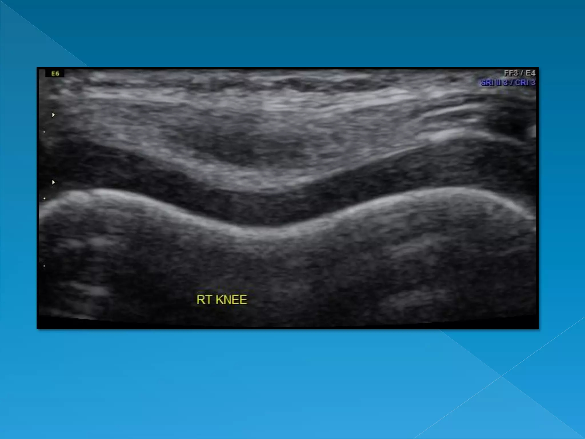Msk US LL anatomy & technique pdf | PDF