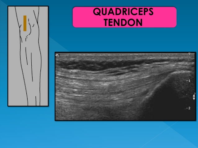 Msk US LL anatomy & technique pdf | PPT