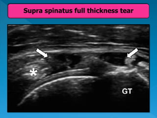 MSK US UL pathology pdf | PPT