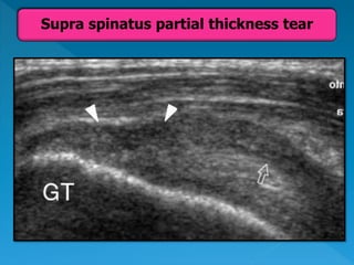 MSK US UL pathology pdf | PPT