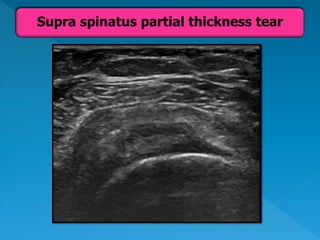 MSK US UL pathology pdf | PPT