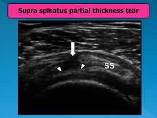 MSK US UL pathology pdf | PPT