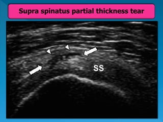 MSK US UL pathology pdf | PPT