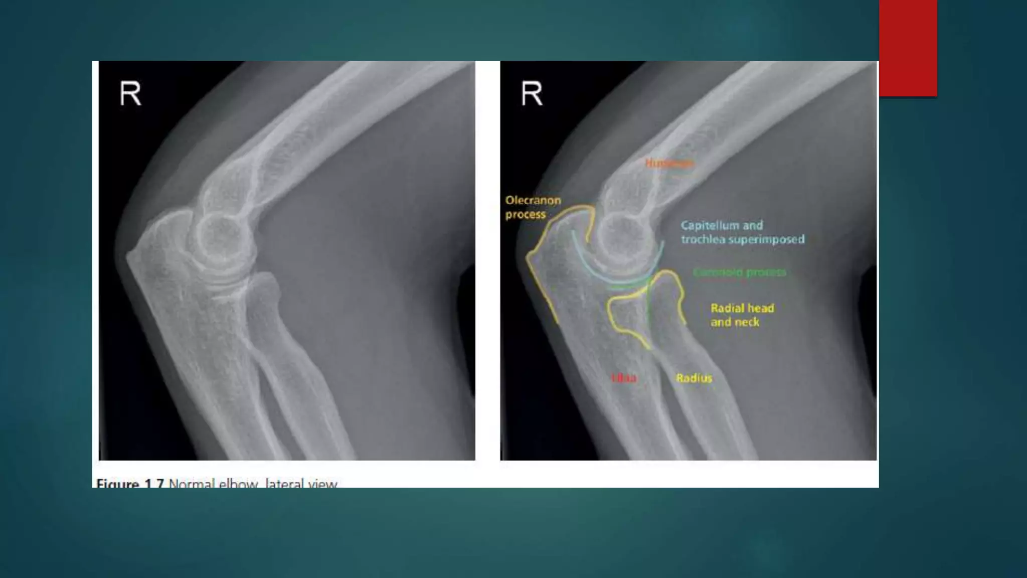 Msk x ray normal anatomy | PPTX
