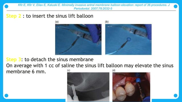 MSLP : Maxillary sinus lift procedures ppt | PPTX