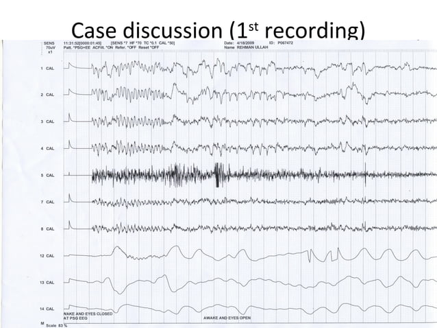 Multiple sleep latency Test (MSLT) and Maintenance of Wakefulness Test ...