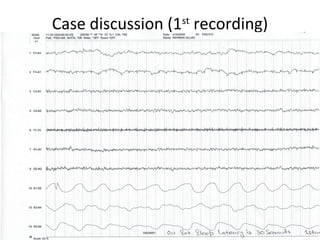 Multiple sleep latency Test (MSLT) and Maintenance of Wakefulness Test ...
