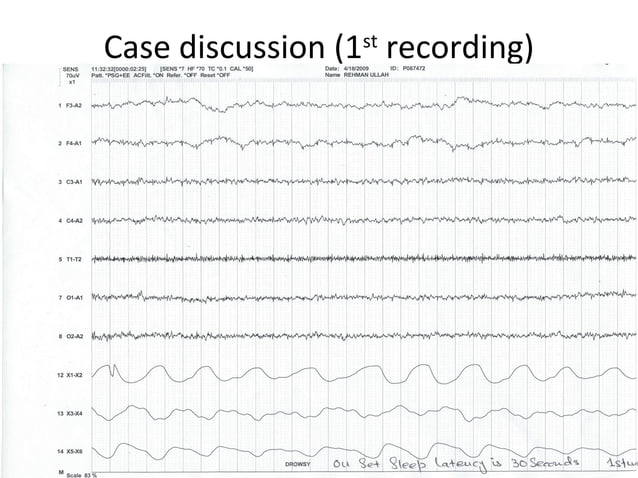 Multiple sleep latency Test (MSLT) and Maintenance of Wakefulness Test ...