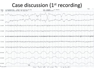 Multiple sleep latency Test (MSLT) and Maintenance of Wakefulness Test ...