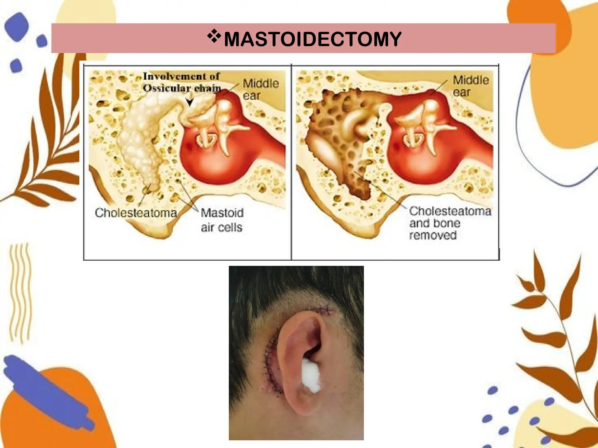 MASTOIDITIS Medical-Surgcal Nursing.pptx