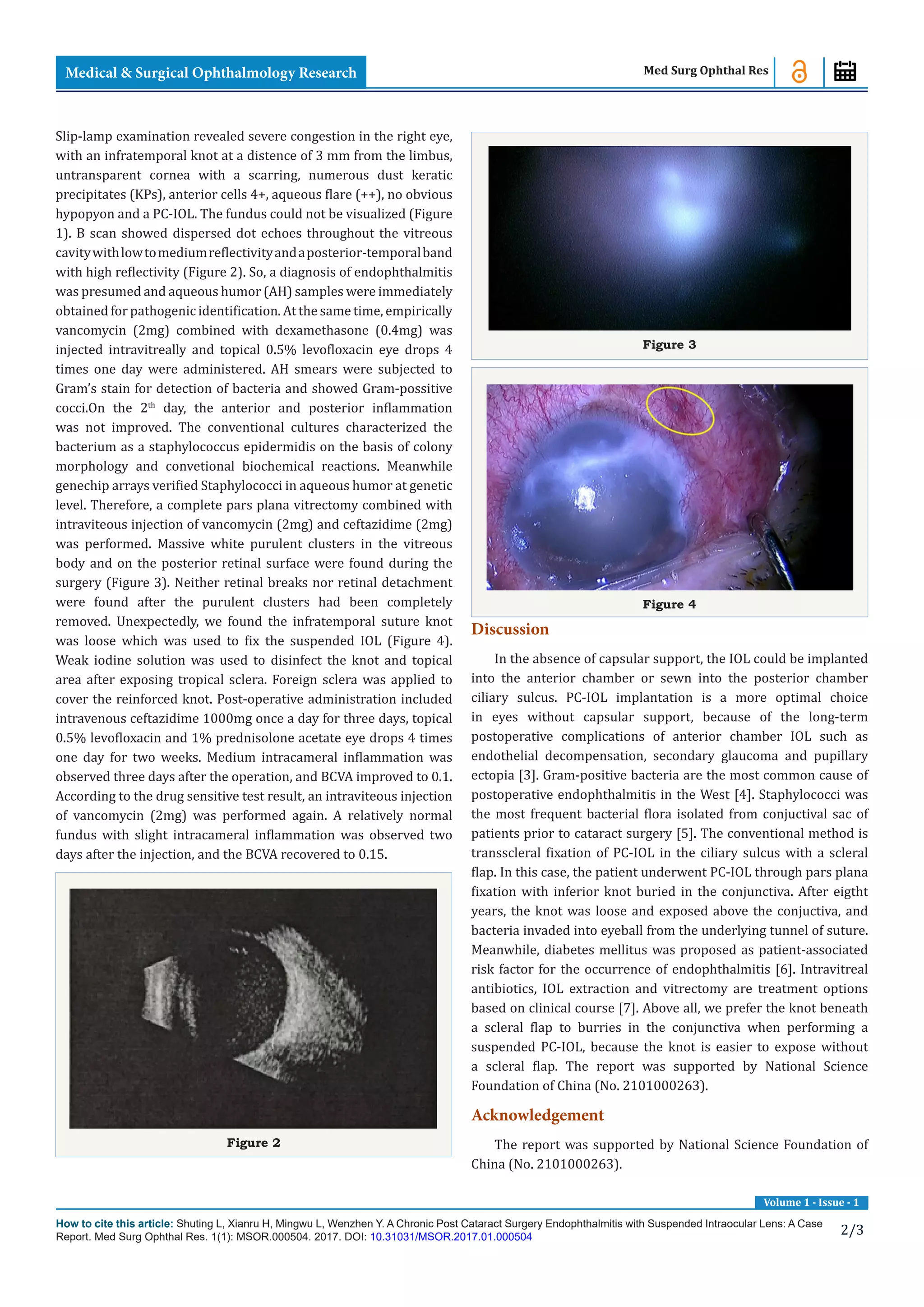 A Chronic Post Cataract Surgery Endophthalmitis with Suspended Intraocular Lens: A Case Report ...
