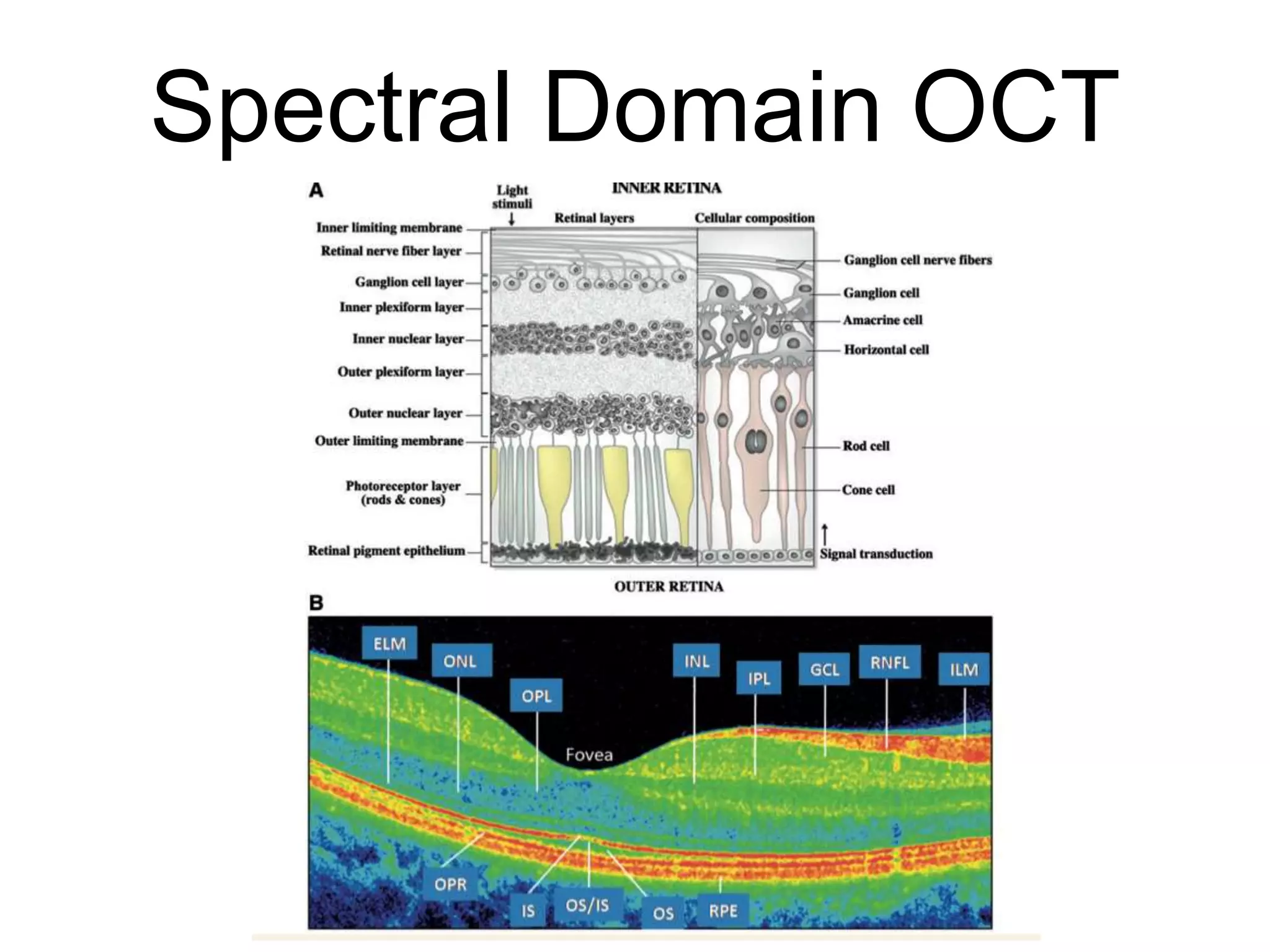 Optic Neuritis and OCT in Multiple Sclerosis | PPTX